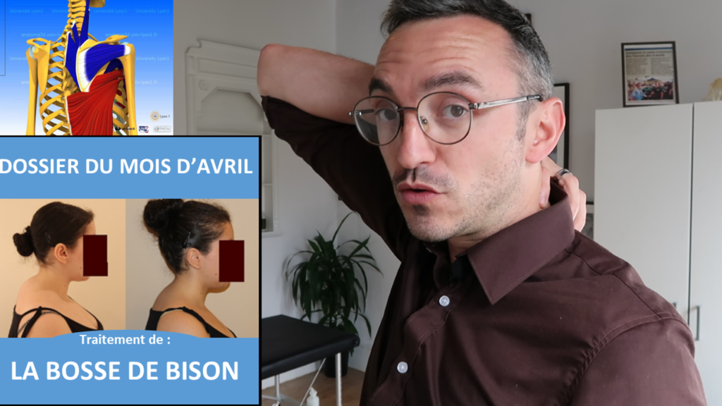 Maximilien vergnaud ostéopathe - La bosse de bison, posture ou Cushing?